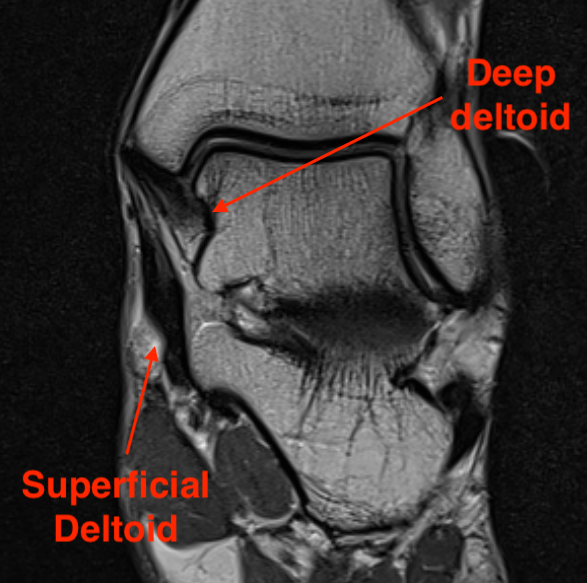 Deltoid ligament injury | The Bone School